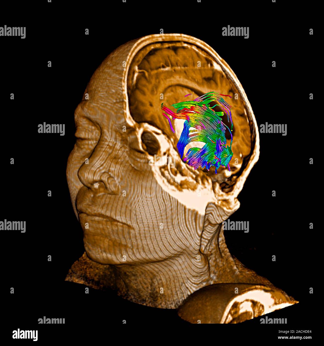 Tumeur au cerveau. 3D couleur l'imagerie du tenseur de diffusion (DTI) et l'imagerie par ...