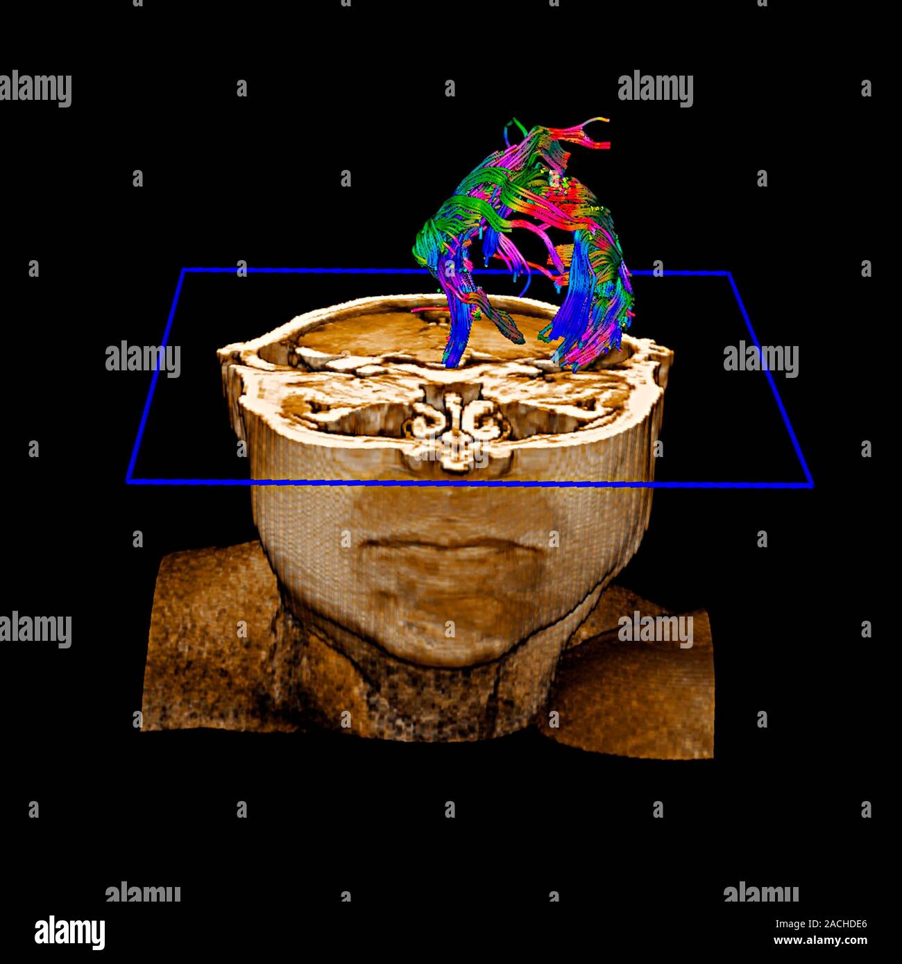 Tumeur au cerveau. 3D couleur l'imagerie du tenseur de diffusion (DTI) et l'imagerie par ...