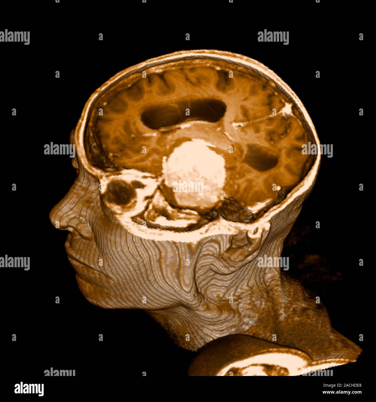 Tumeur au cerveau. Couleur l'imagerie par résonance magnétique (IRM) du cerveau d'un 64 ans avec ...
