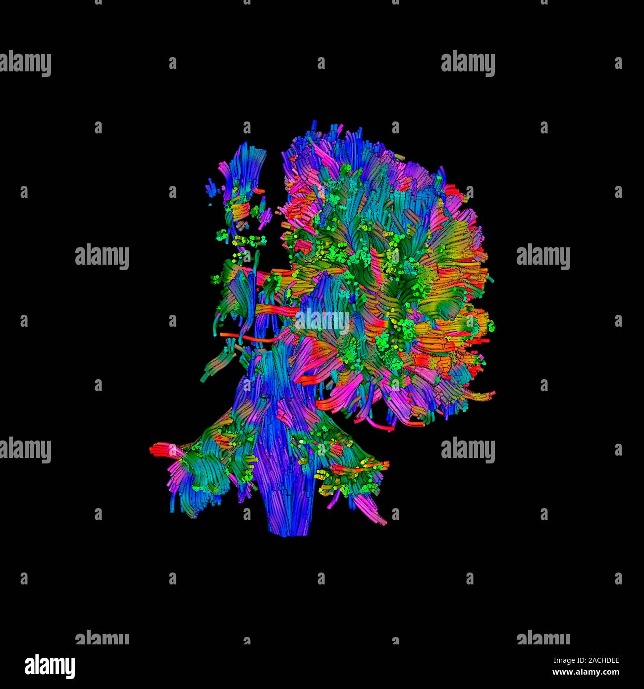 La paralysie cérébrale. 3D couleur l'imagerie du tenseur de diffusion (DTI) scan d'une vue ...