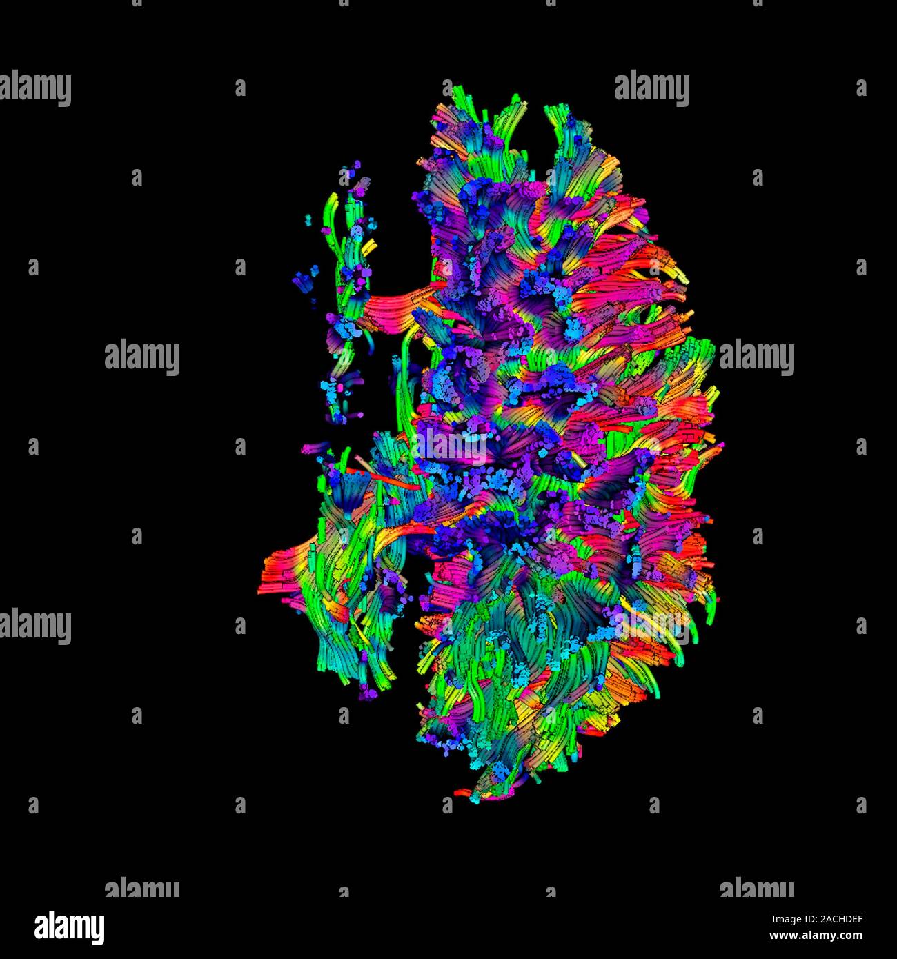 La paralysie cérébrale. 3D couleur l'imagerie du tenseur de diffusion (DTI) du cerveau d'un 23 ...