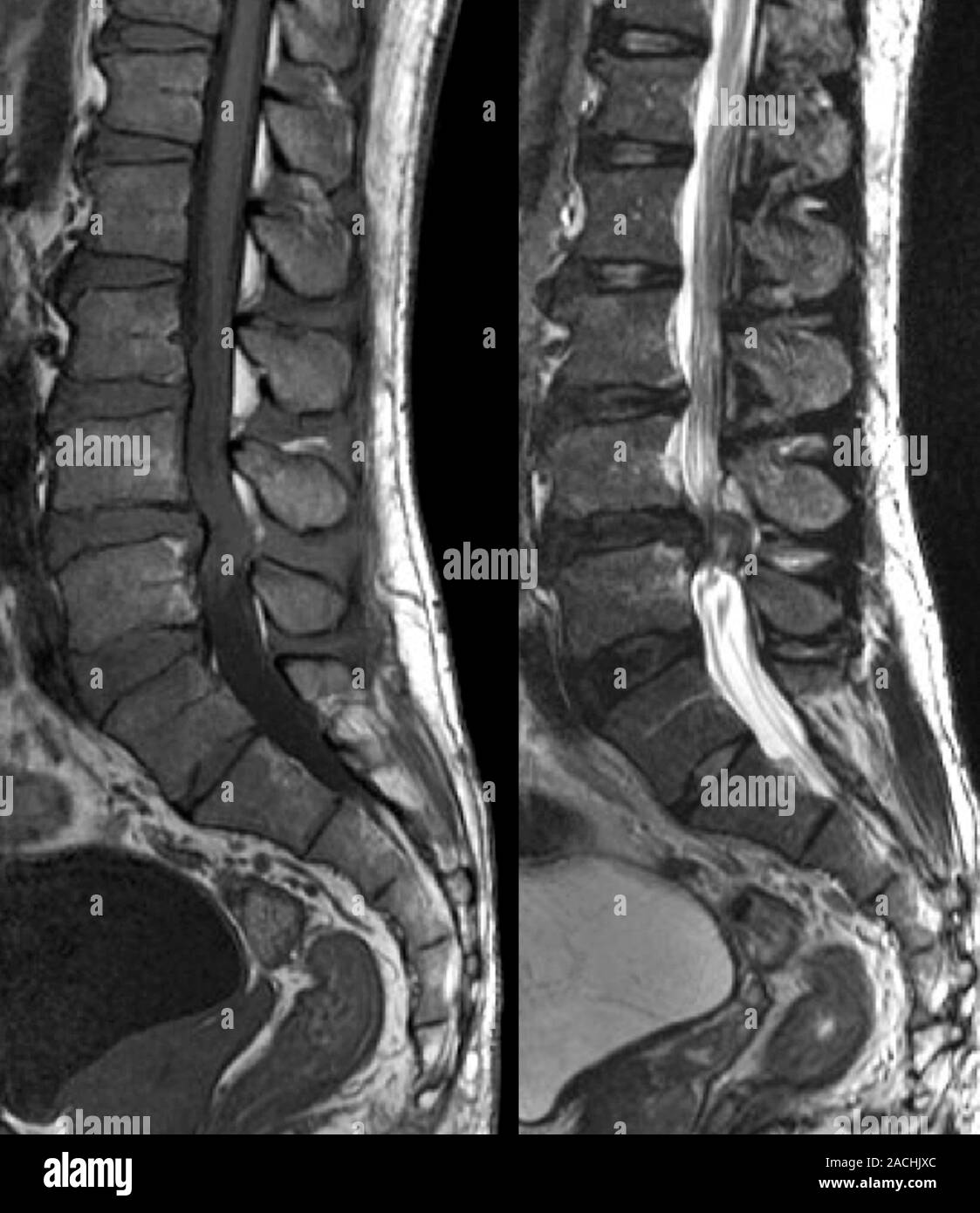 La douleur nerf spinal. Coupe sagittale de l'imagerie par résonance ...