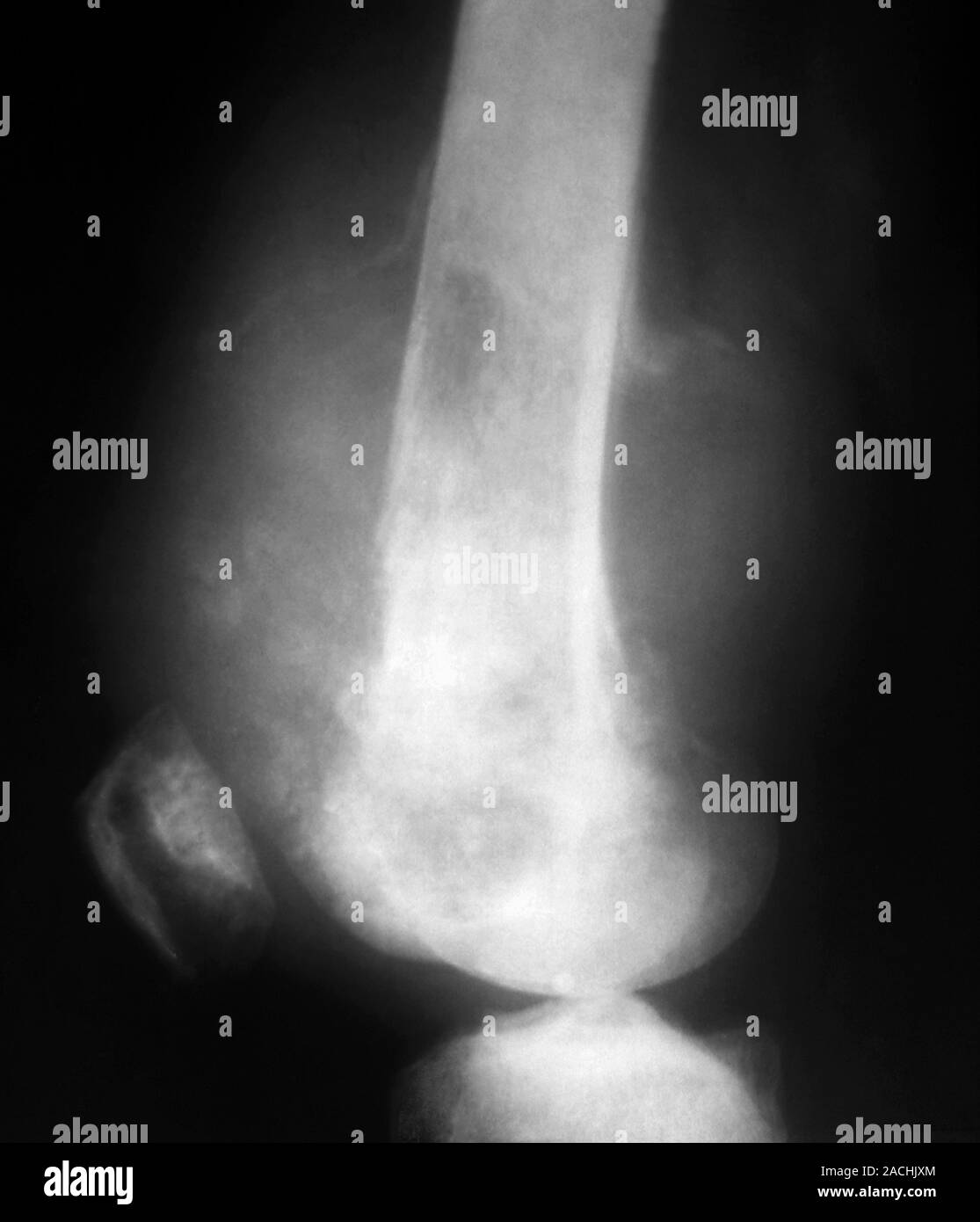 Le cancer des os dans le fémur. Radiographie latérale d'une tumeur ...