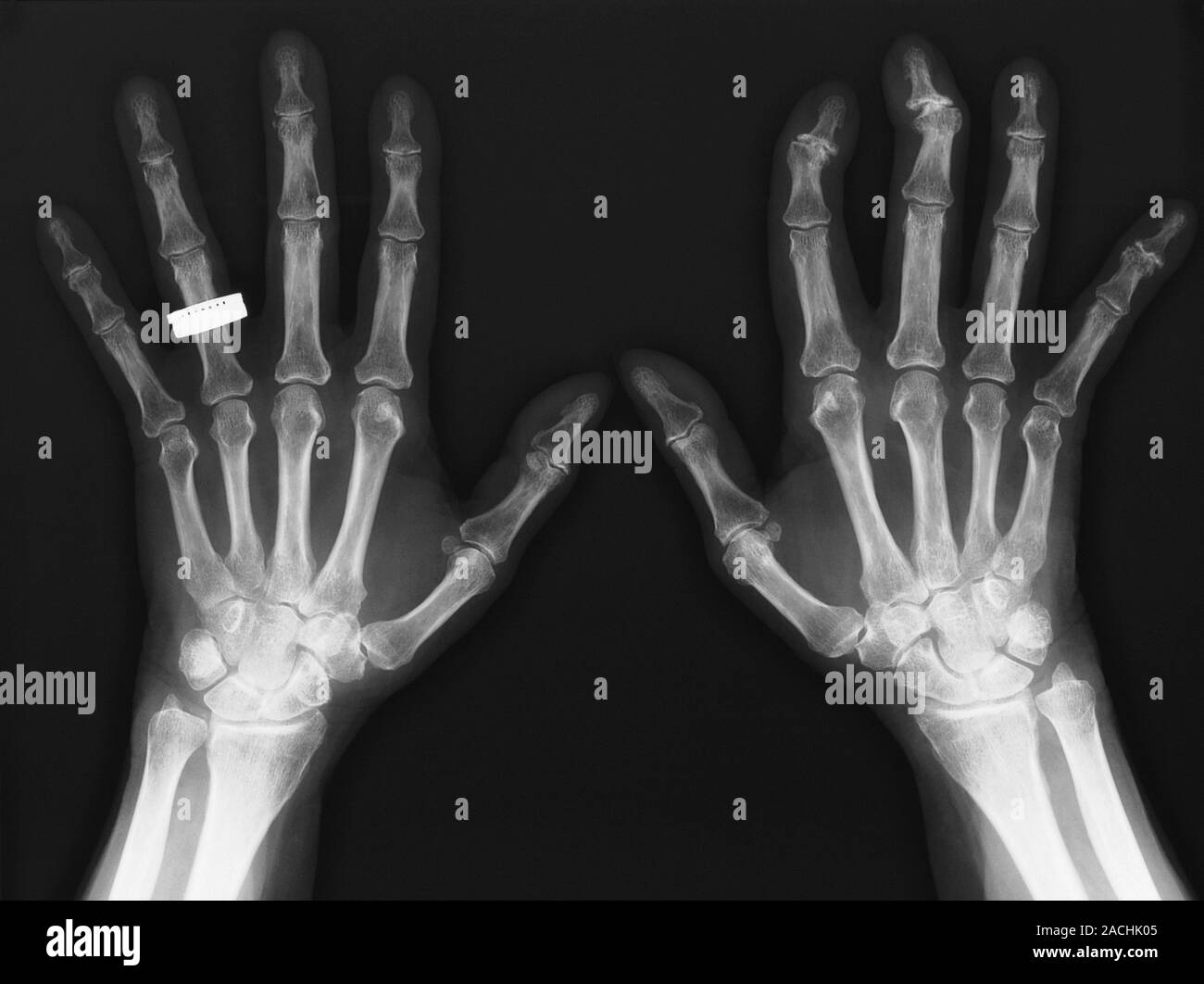 L'arthrite rhumatoïde. Des radiographies frontale bilatérale des mains ...
