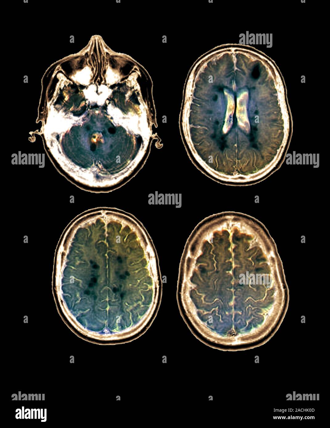 Syndrome cérébral pyramidale. Couleur axiale de l'imagerie par ...