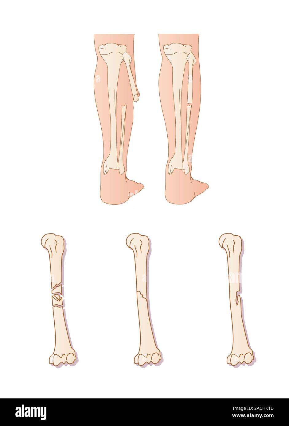 Types de fractures, l'artwork. Les fractures peuvent être ouverts ...