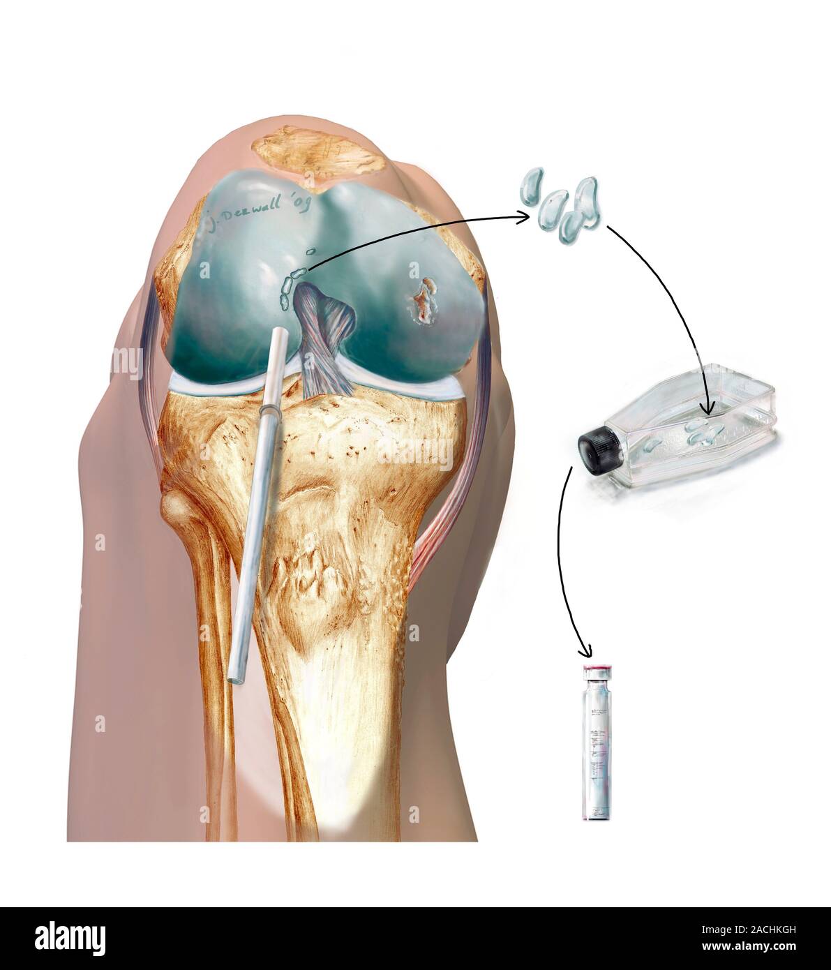 La reconstruction du cartilage du genou. Artwork montrant les premières ...
