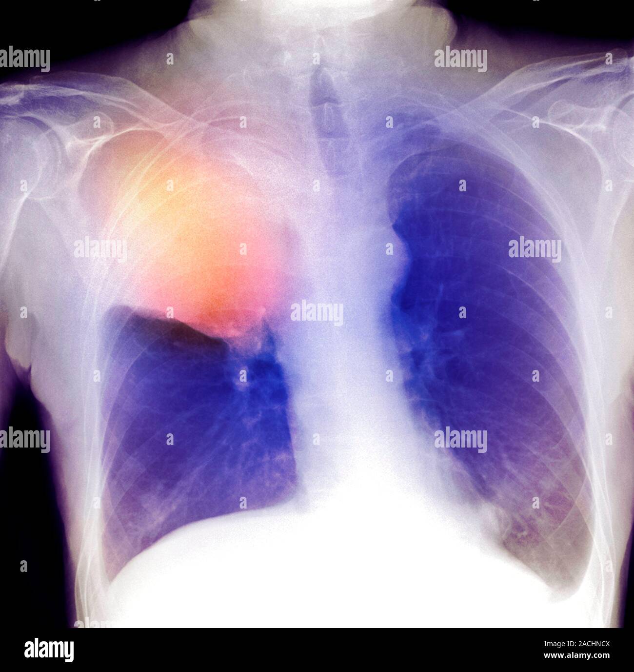 Le cancer du poumon. X-ray frontal couleur montrant un carcinome ...