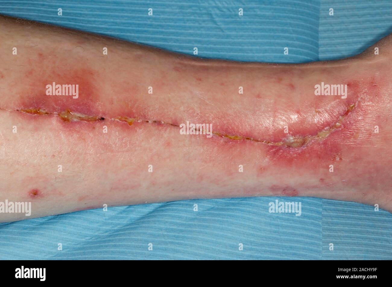 Plaies infectées et de la cicatrice sur la jambe d'un patient âgé de 67 ...