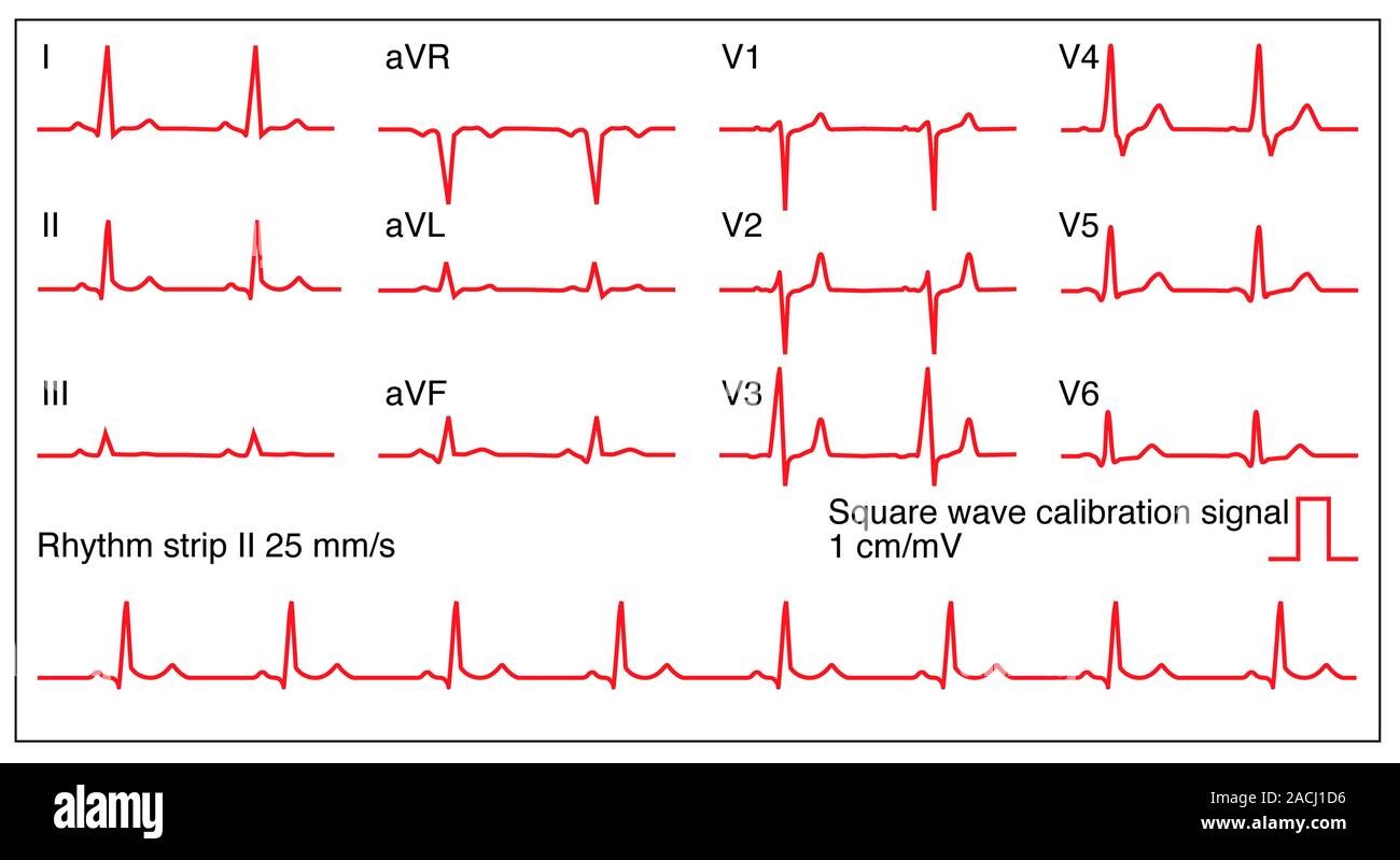 Les électrocardiogrammes (ECG) d'une fréquence cardiaque normale ...