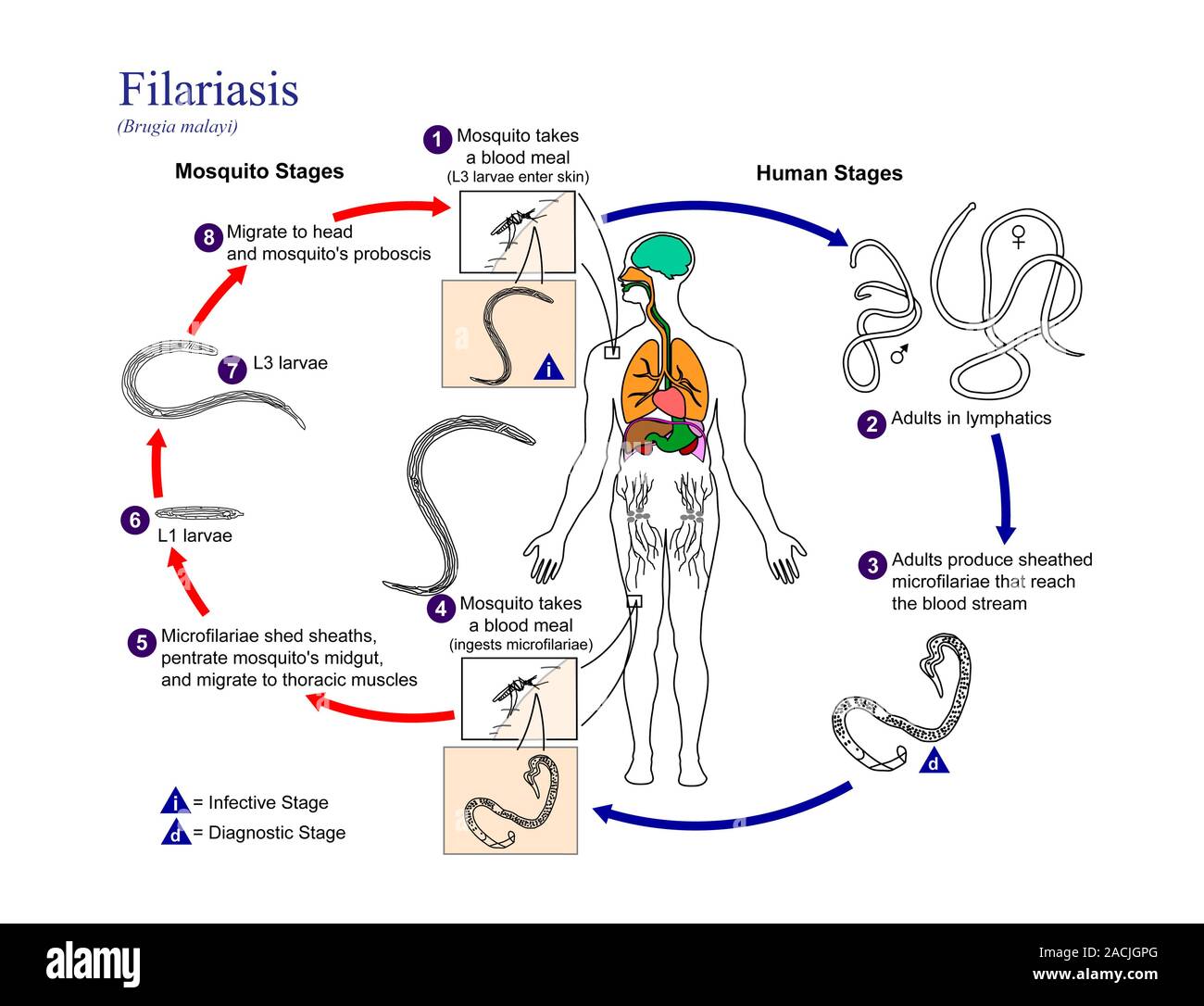 Filariose Lymphatique Photo – Filariose Lymphatique Causes Principales ...