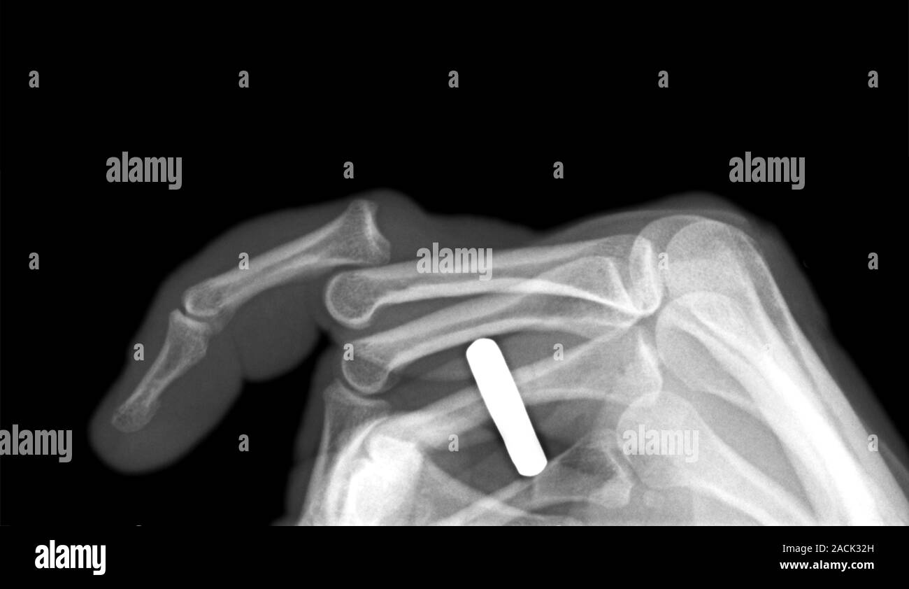 Luxation de doigt. Radiographie d'un patient âgé de 40 ans avec une ...