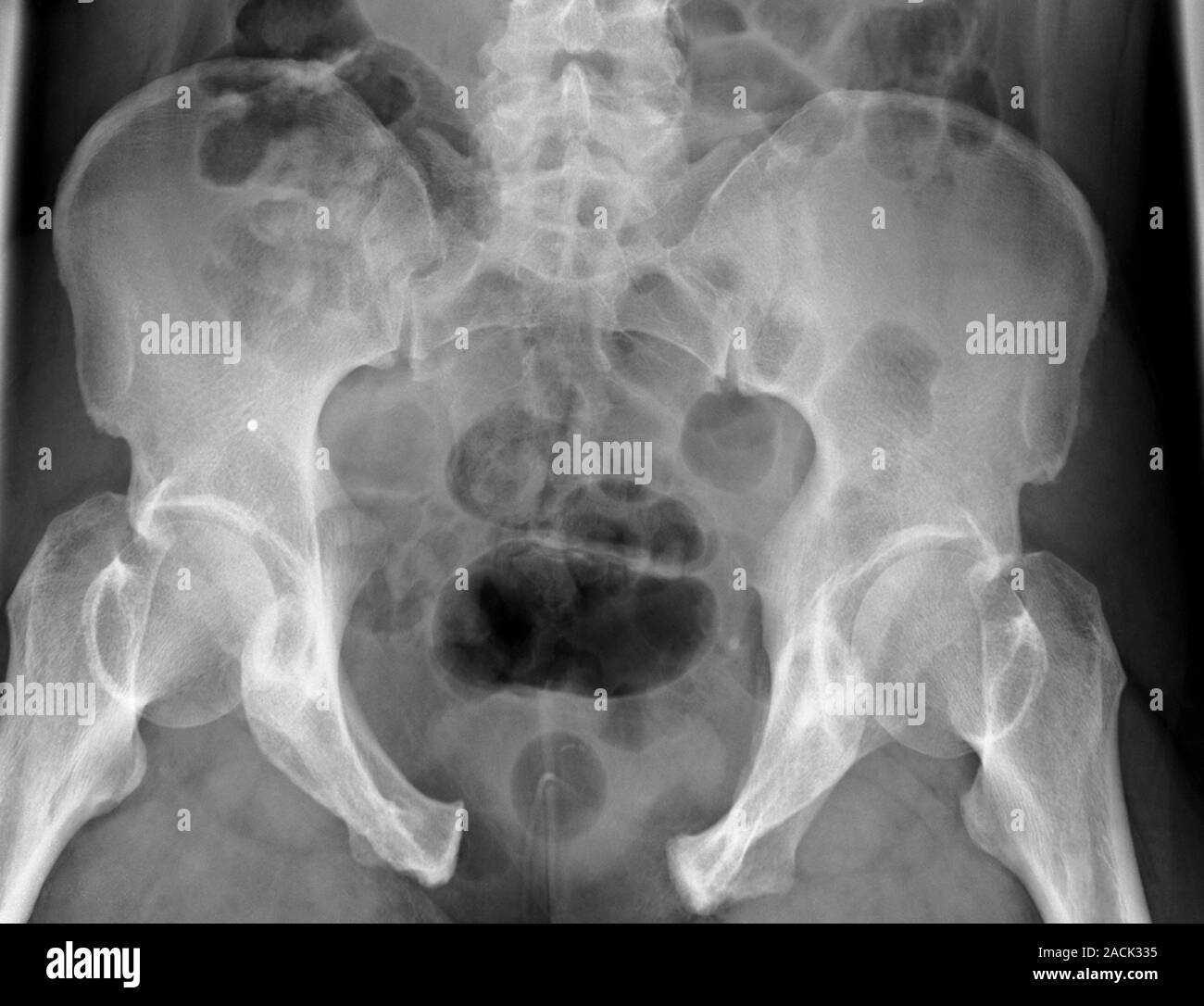 Fracture du bassin. X-ray du bassin de l'a 61 ans homme patient avec un ...