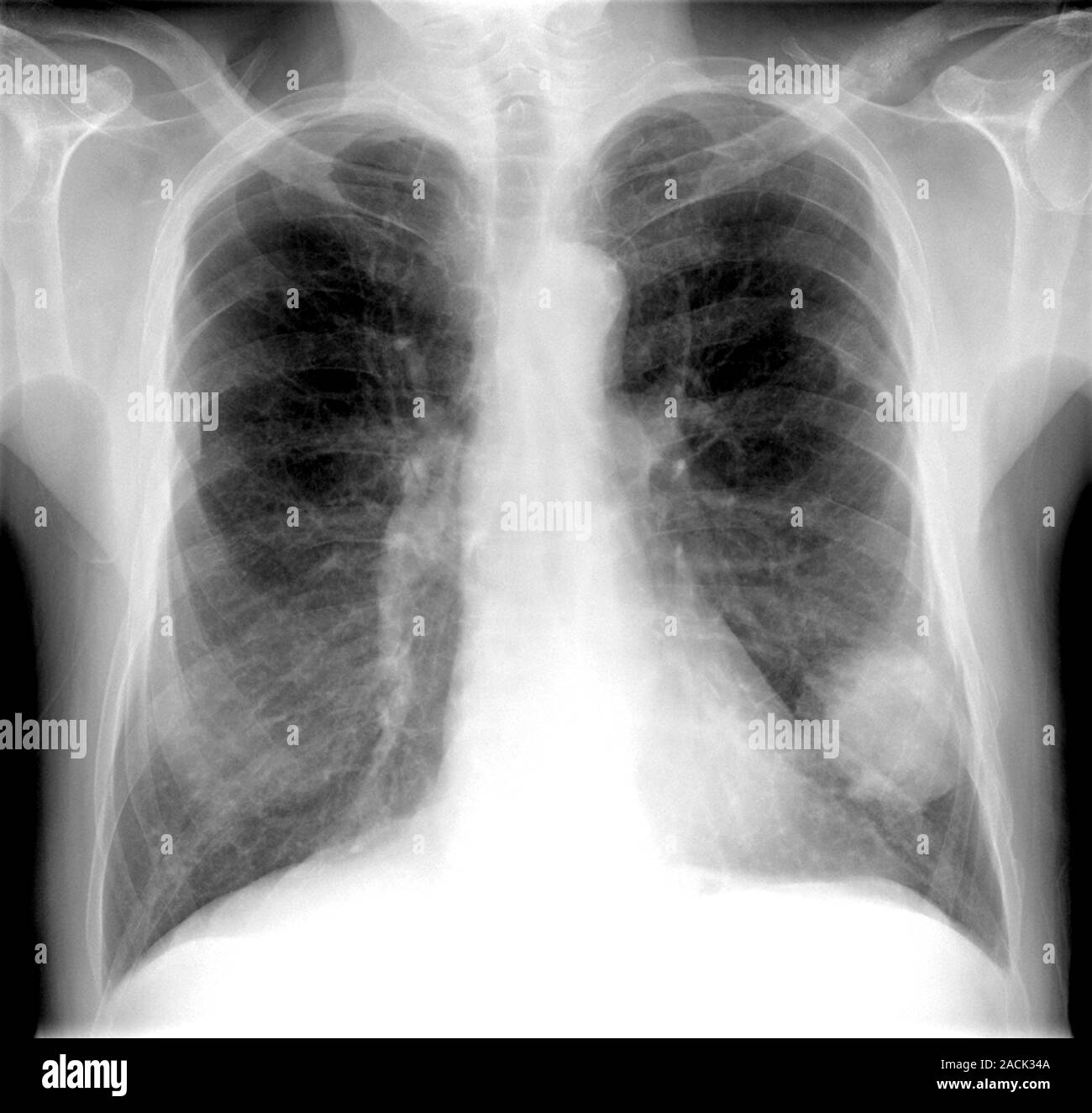 Le cancer du poumon. La radiographie du thorax d'un patient âgé de 69 ...