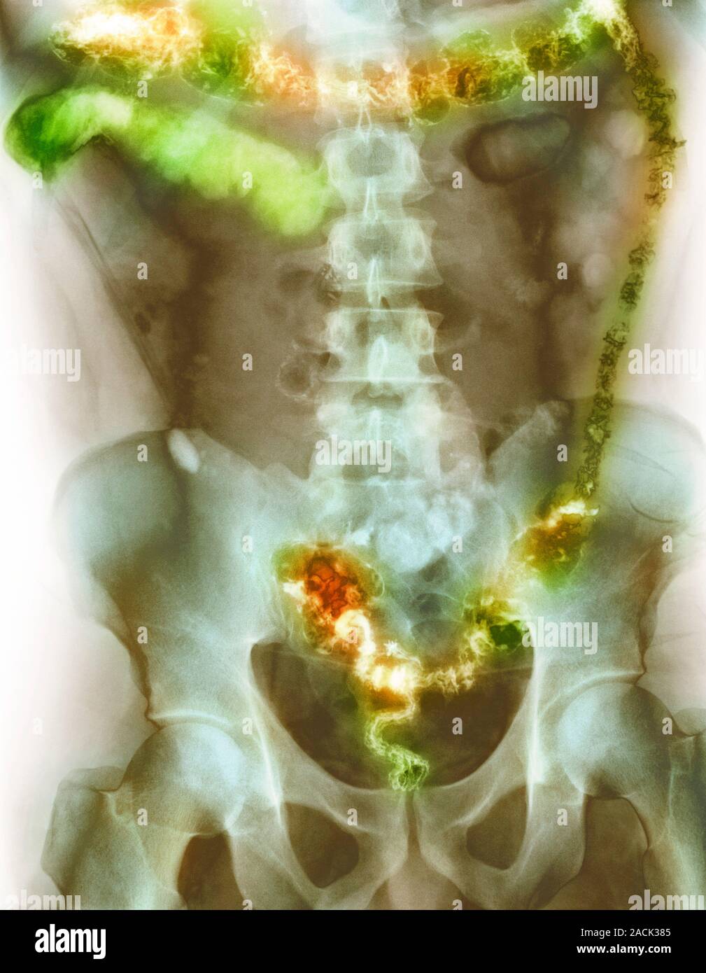 La colite ulcéreuse. X-ray de couleur de l'abdomen de l'homme de 30 ans ...