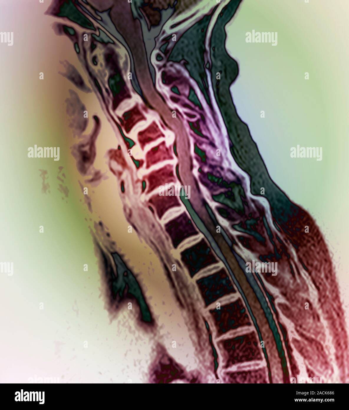 Hernie discale, coloré de l'imagerie par résonance magnétique (IRM ...