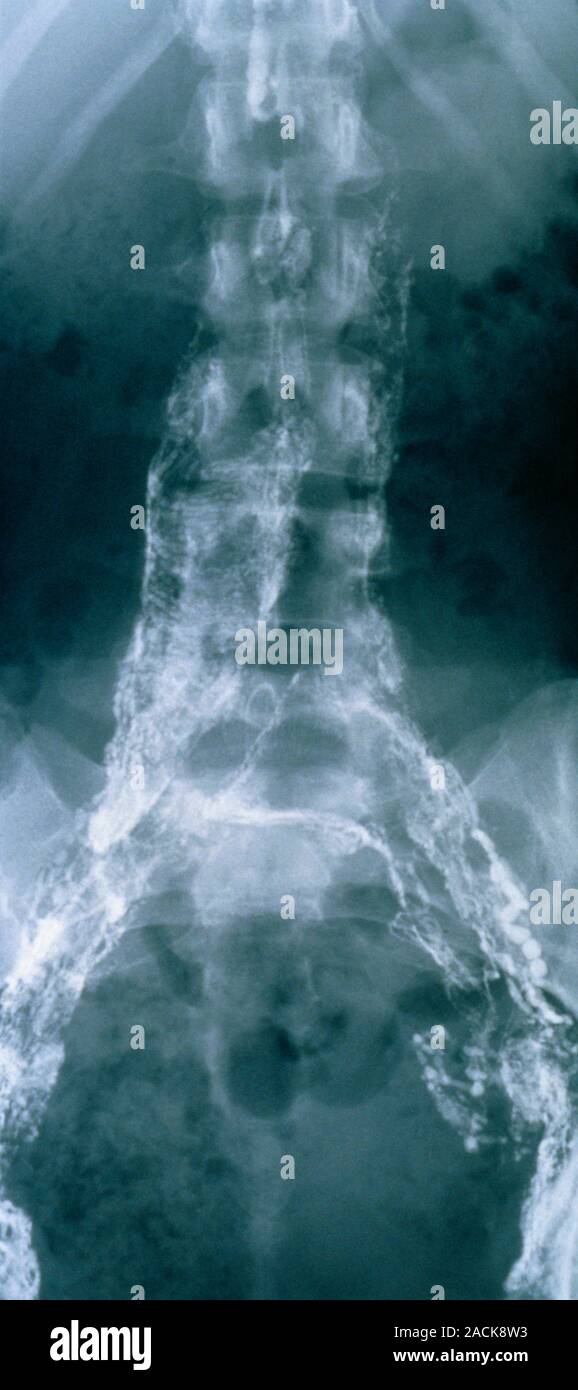 Les vaisseaux lymphatiques de l'abdomen. Lymphography (navire de lymphe ...
