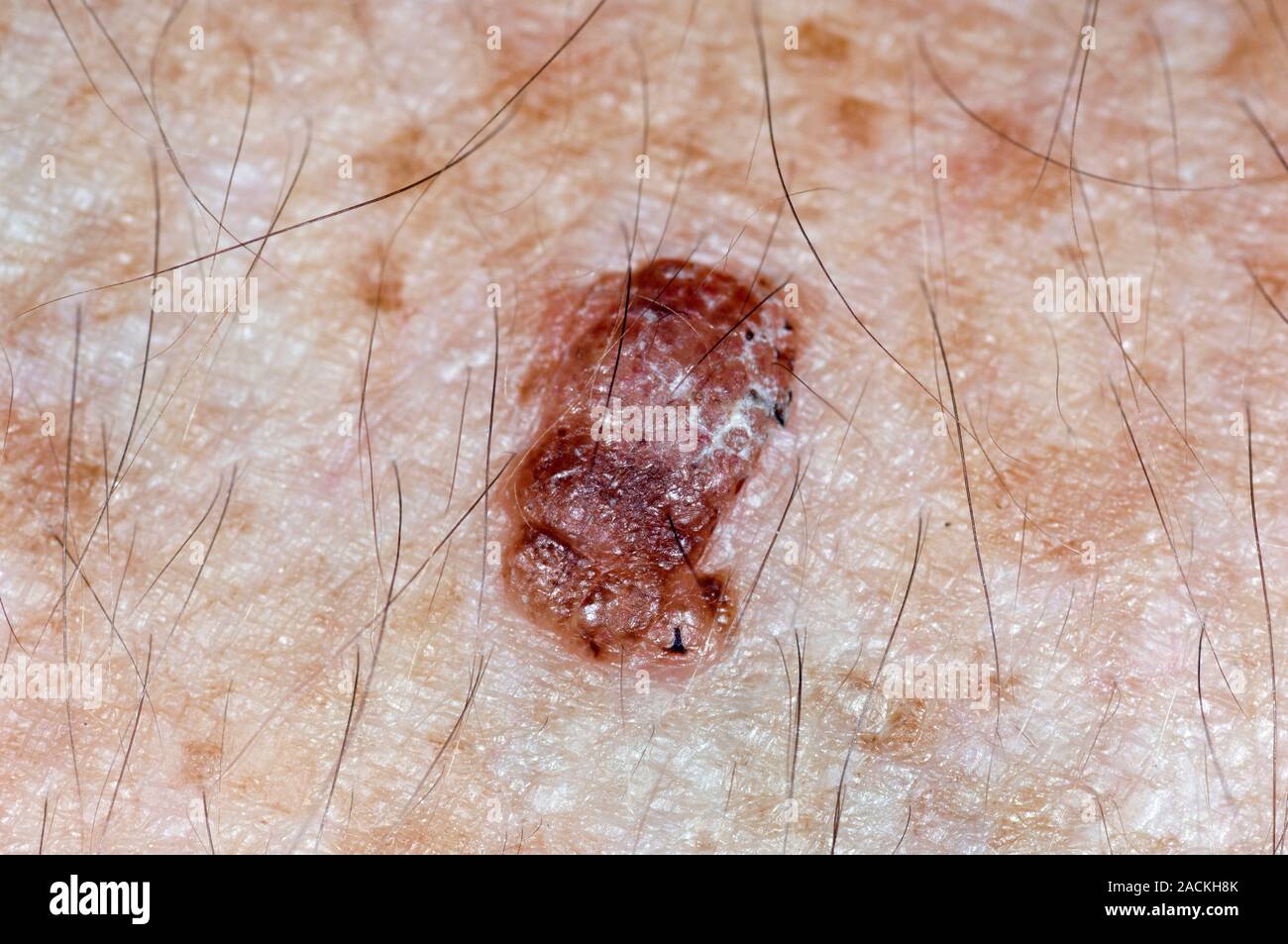 Close-up d'une verrue séborrhéique de la peau d'une patiente âgée de 75 ...