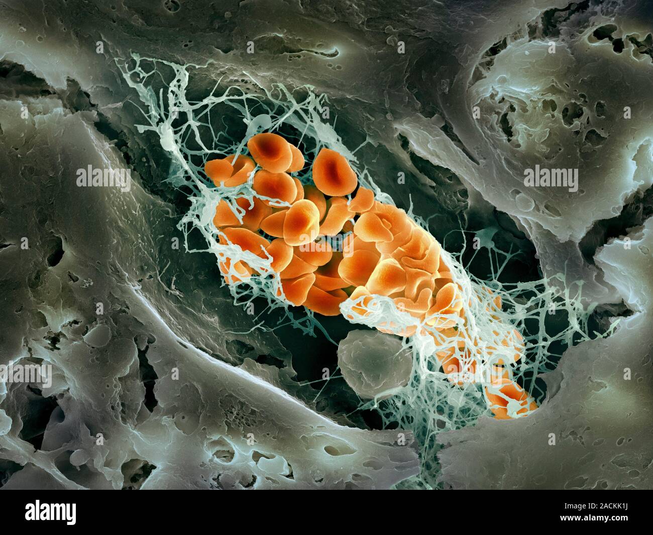 Caillot de sang. Couleur de l'analyse des électrons Microphotographie ...