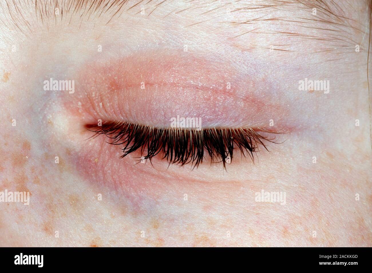 L'eczéma sur la paupière d'une patiente âgée de 9 ans. L'eczéma est une ...
