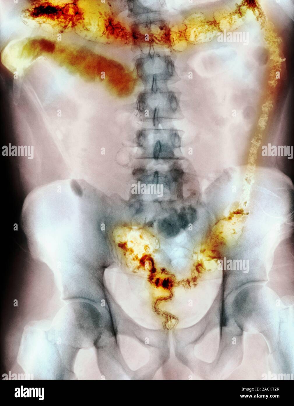 La colite ulcéreuse. X-ray de couleur de l'abdomen de l'homme de 30 ans ...