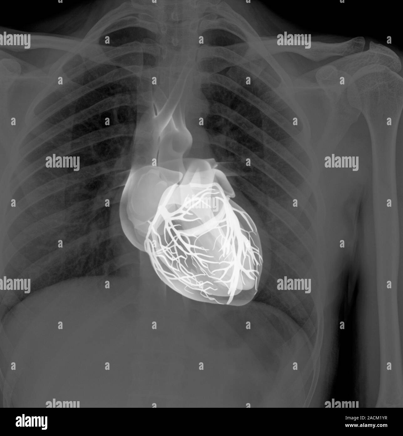 Coeur et poumons, radiographie du composite. Le coeur X-ray (centre) a ...