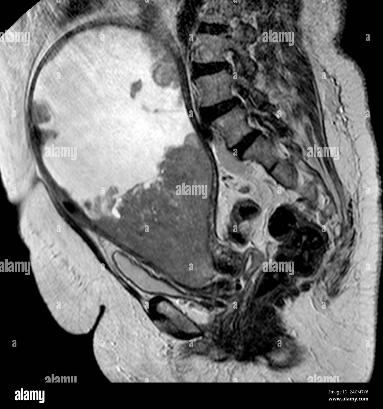 Le cancer de l'utérus. L'imagerie par résonance magnétique (IRM) de l ...
