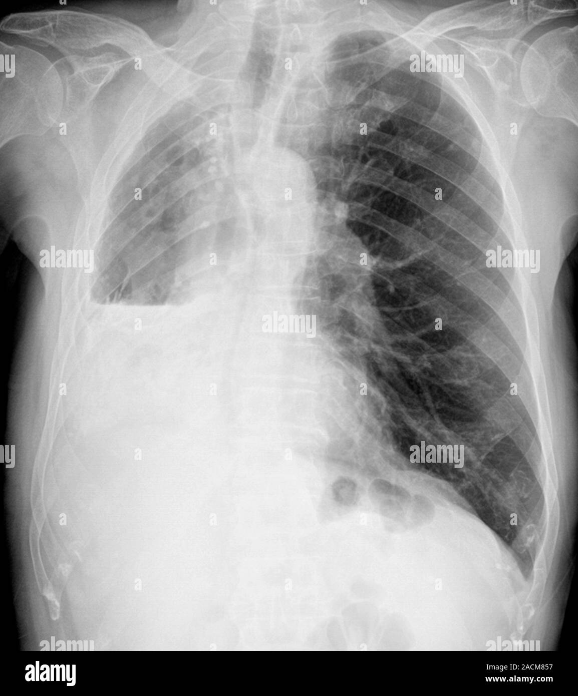 La radiographie du thorax (vue de face) d'un patient âgé de 80 ans avec ...