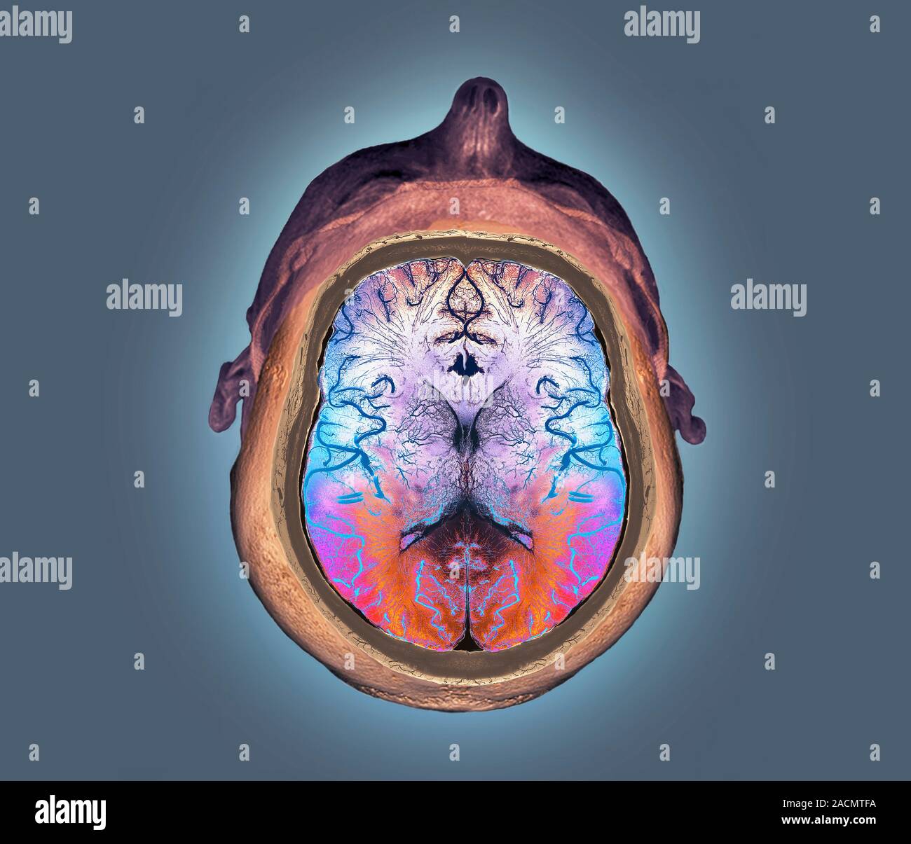 Un cerveau normal. 3D computed tomography (CT scan) d'une section à ...