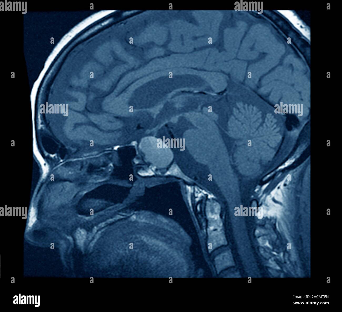 Tumeur au cerveau. L'imagerie par résonance magnétique (IRM) d'une section par l'intermédiaire d ...