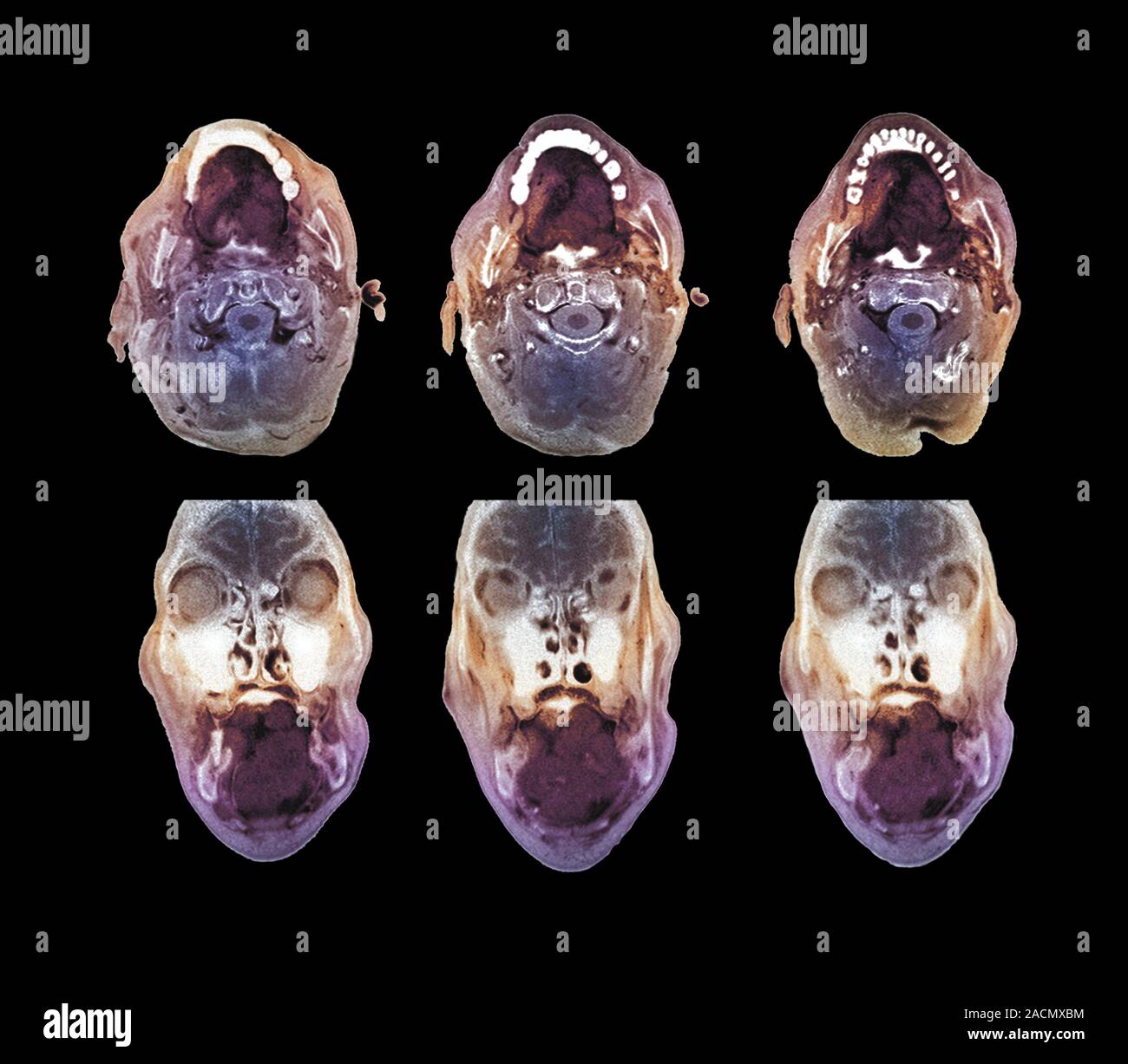 Le cancer de la langue. L'imagerie par résonance magnétique de couleur ...