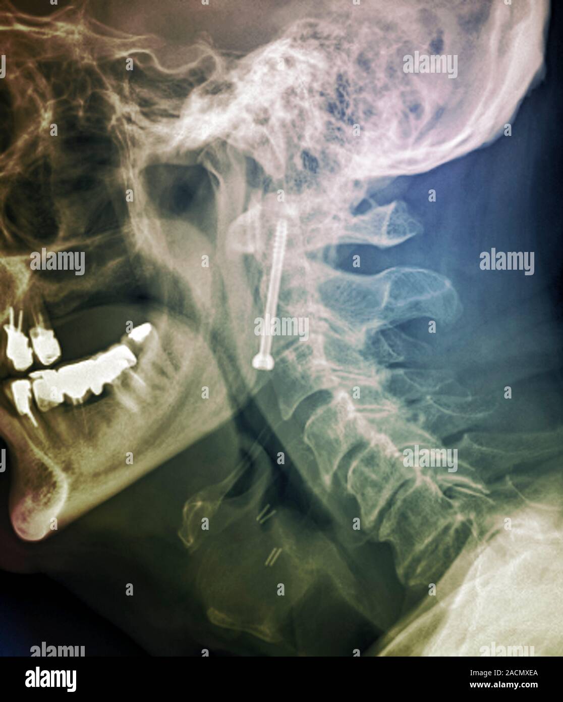 Fracture du col du épinglé. Couleur scanner du crâne et du cou ...