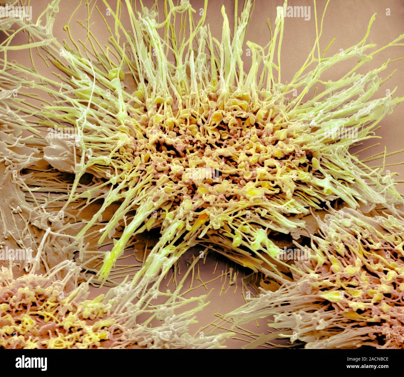 Les cellules de cancer du vagin. Couleur de l'analyse des électrons ...