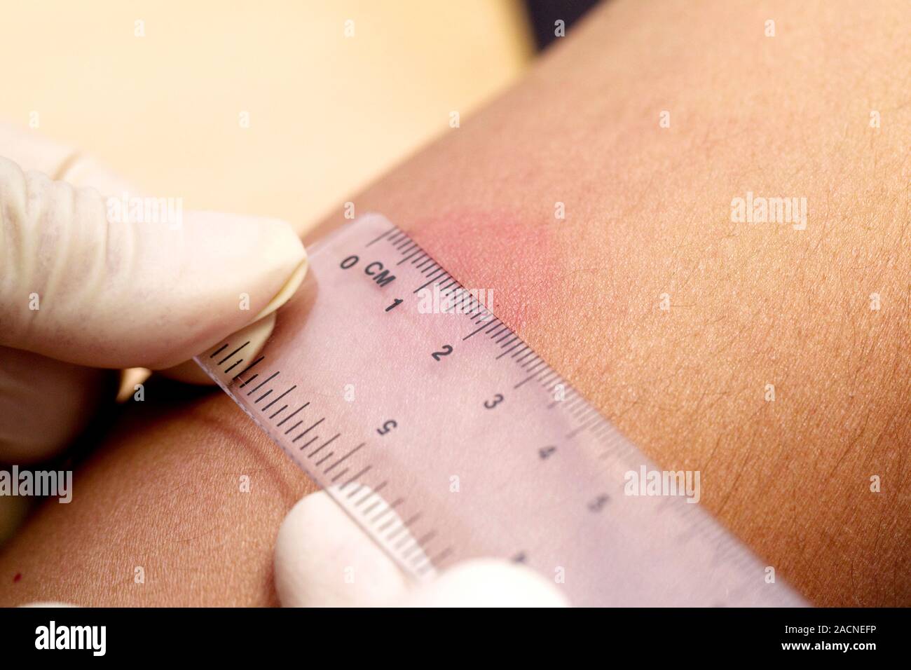 La tuberculose (TB). Close-up d'une réponse du système immunitaire ...