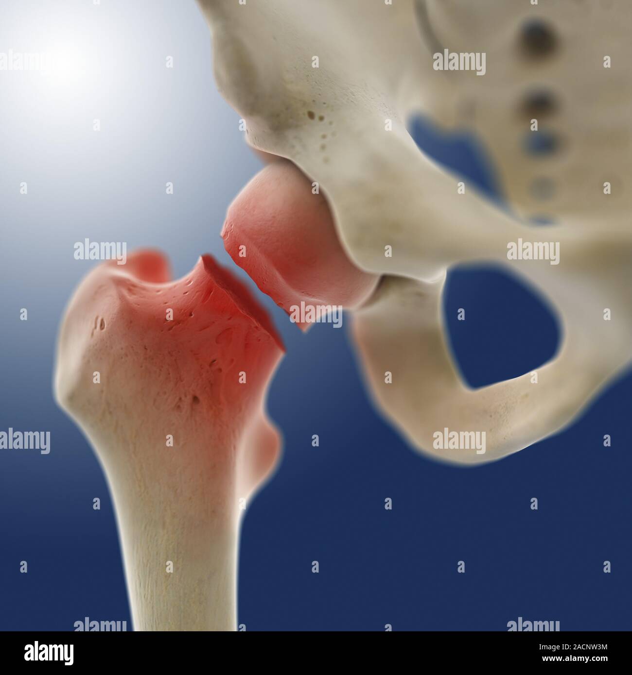 Fracture de la hanche. L'oeuvre de l'ordinateur d'une fracture dans le ...