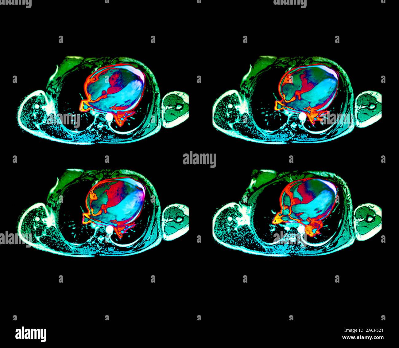 Tumeur au cerveau. L'imagerie par résonance magnétique de couleur (IRM) des sections axial à ...