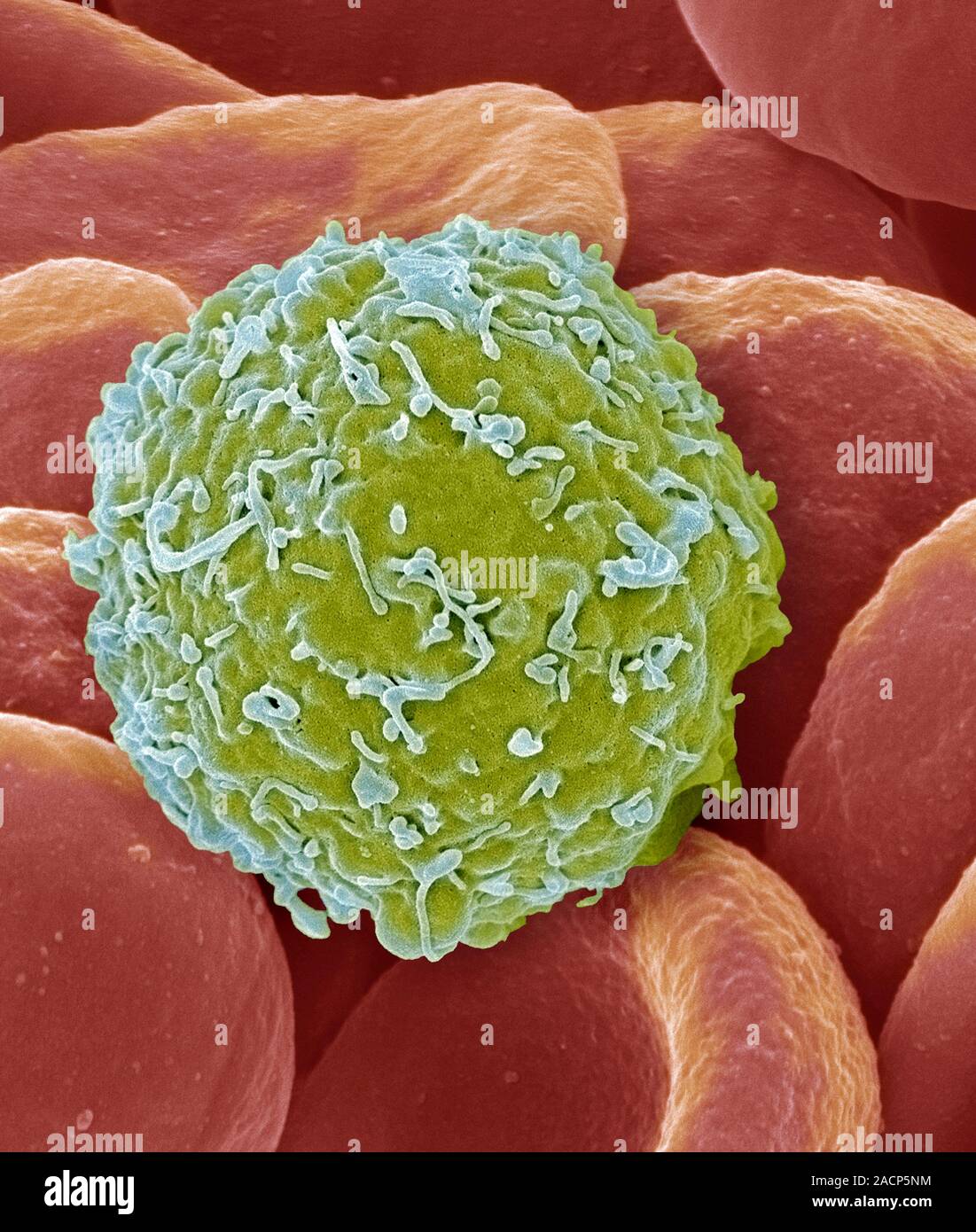 Les cellules leucémiques. Couleur de l'analyse des électrons ...
