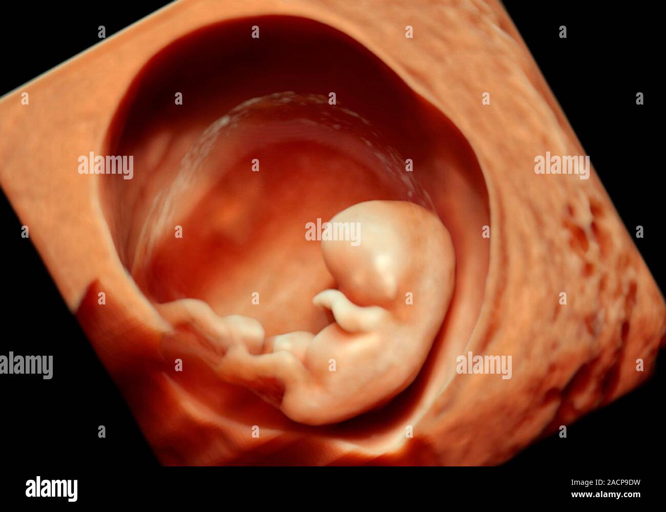Semaine 10 Foetus 3 D échographie Trois Dimensions 3 D échographie