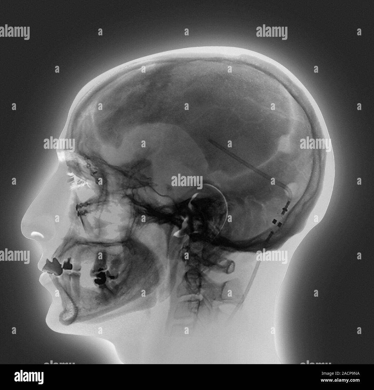 Shunt ventriculaire. X-ray de la tête d'un 52-year-old patient avec ...