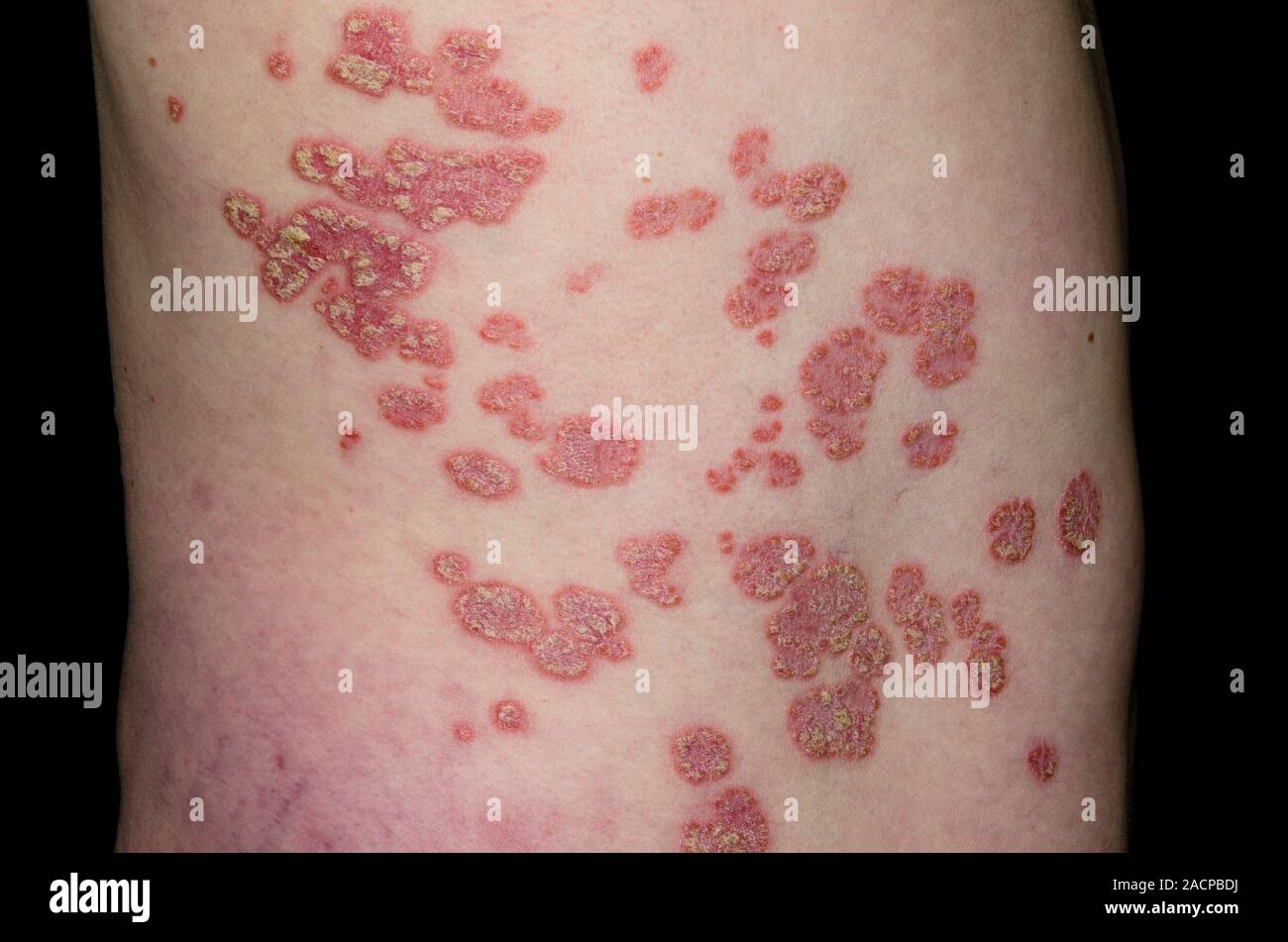 Des plaques rouges (correctifs) du psoriasis sur la peau dans un homme ...