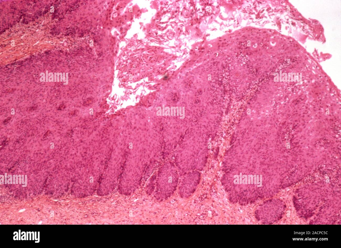 Métaplasie squameuse de l'endomètre. Microphotographie lumière d'une ...