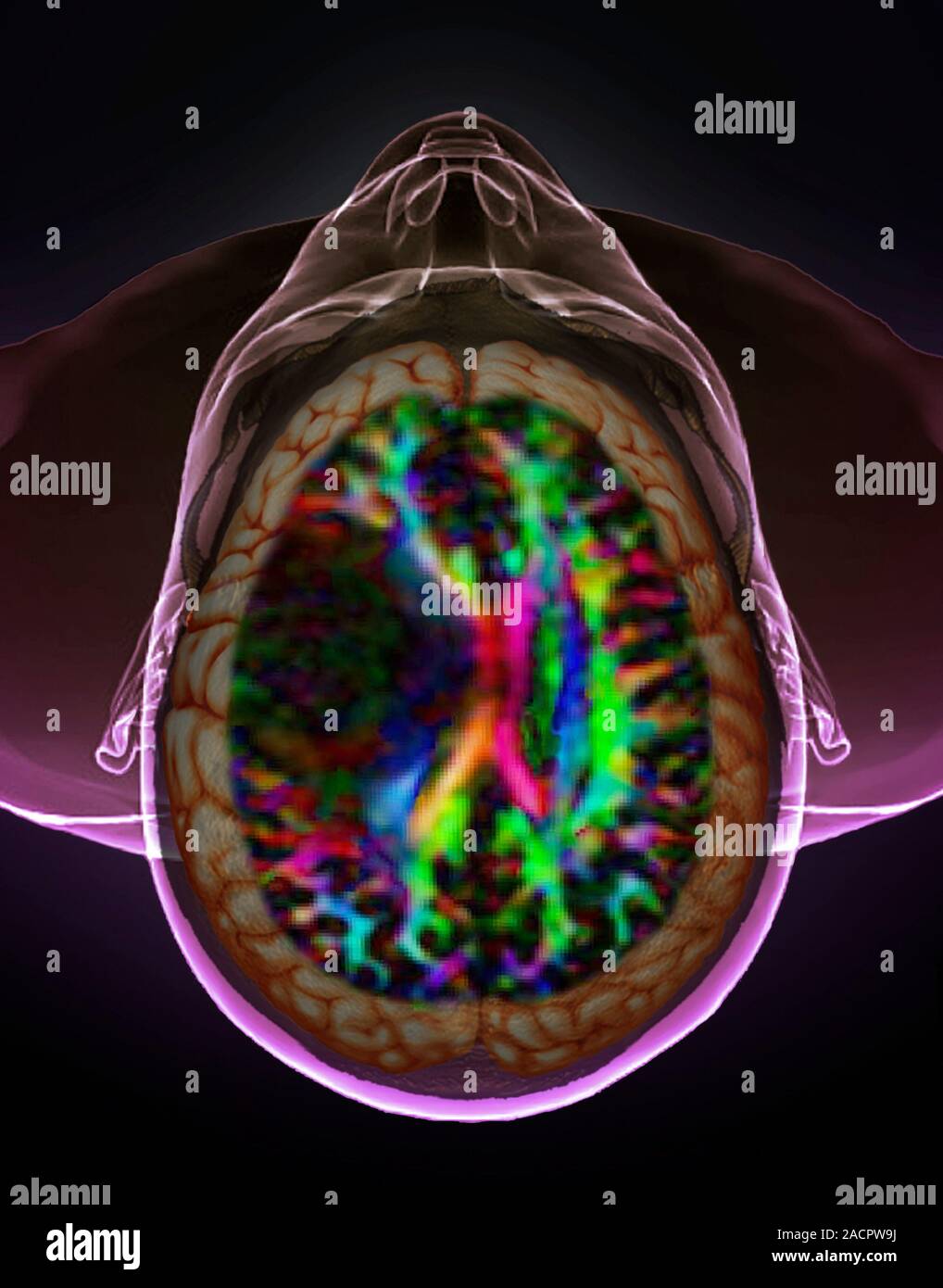 Le cancer du cerveau. Image composite de couleur d'une imagerie du tenseur de diffusion (DTI) du ...