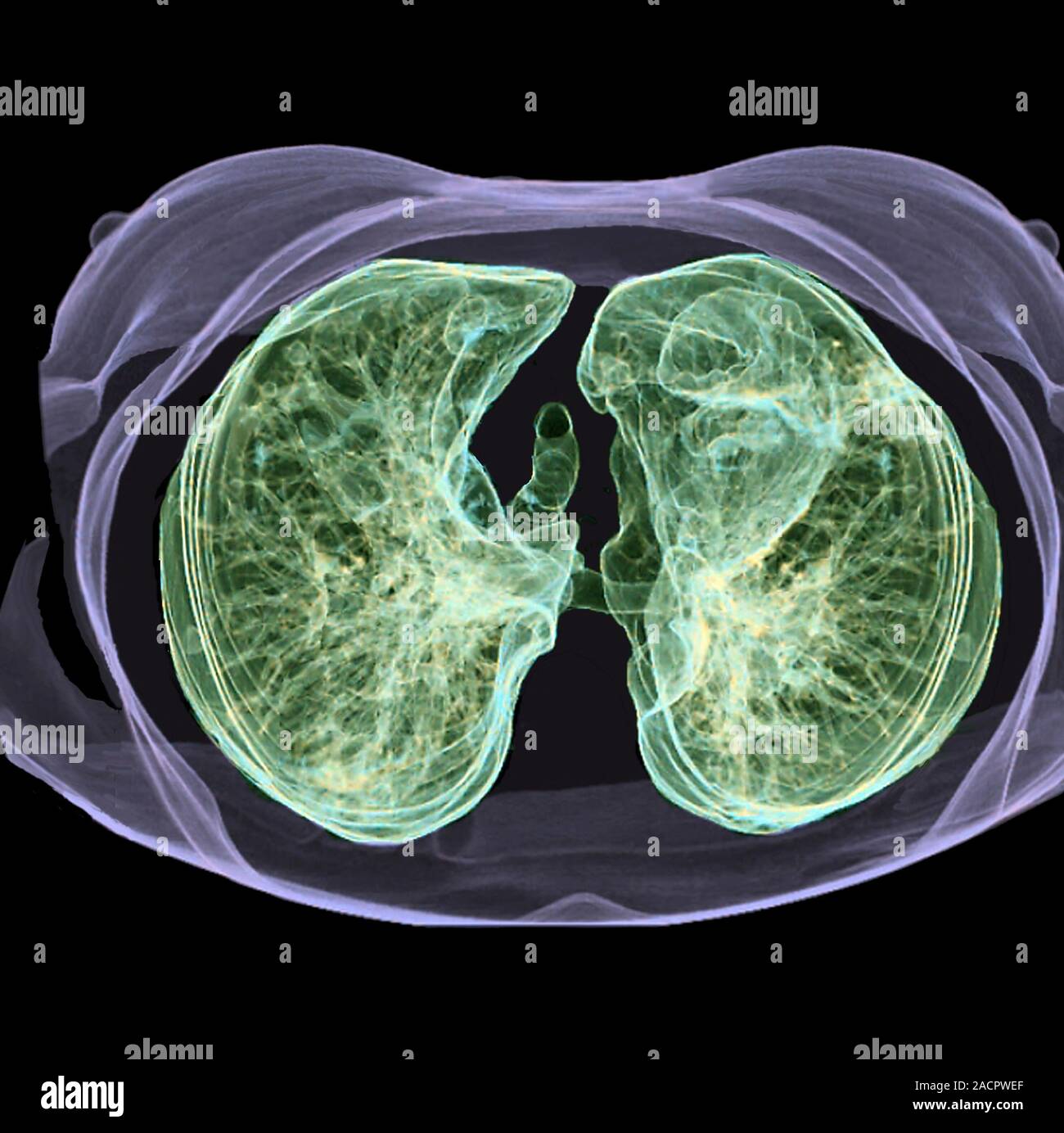 La santé des poumons. 3D couleur Scanner de la poitrine d'un patient de ...