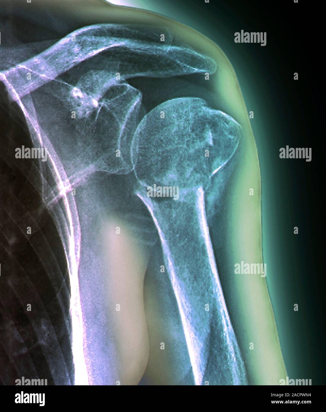 Fracture et luxation de l'épaule. X-ray de couleur de l'épaule d'un ...