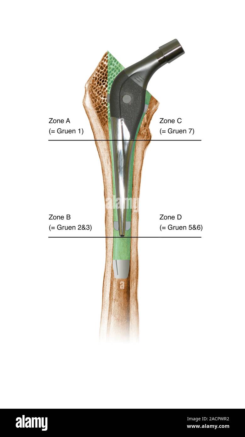 Les prothèses de la hanche et Gruen zones. Schéma en coupe d'un fémur ...