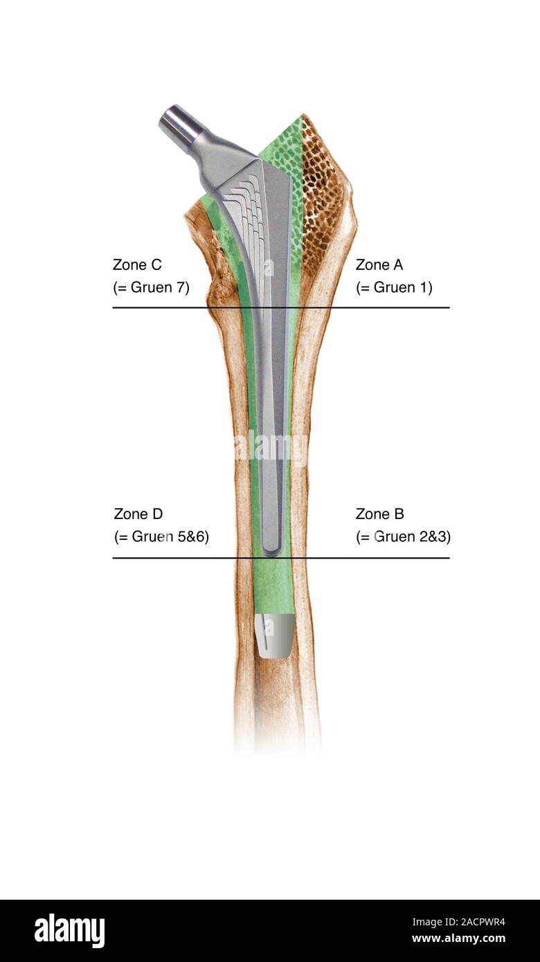 Les prothèses de la hanche et Gruen zones. Schéma en coupe d'un fémur ...