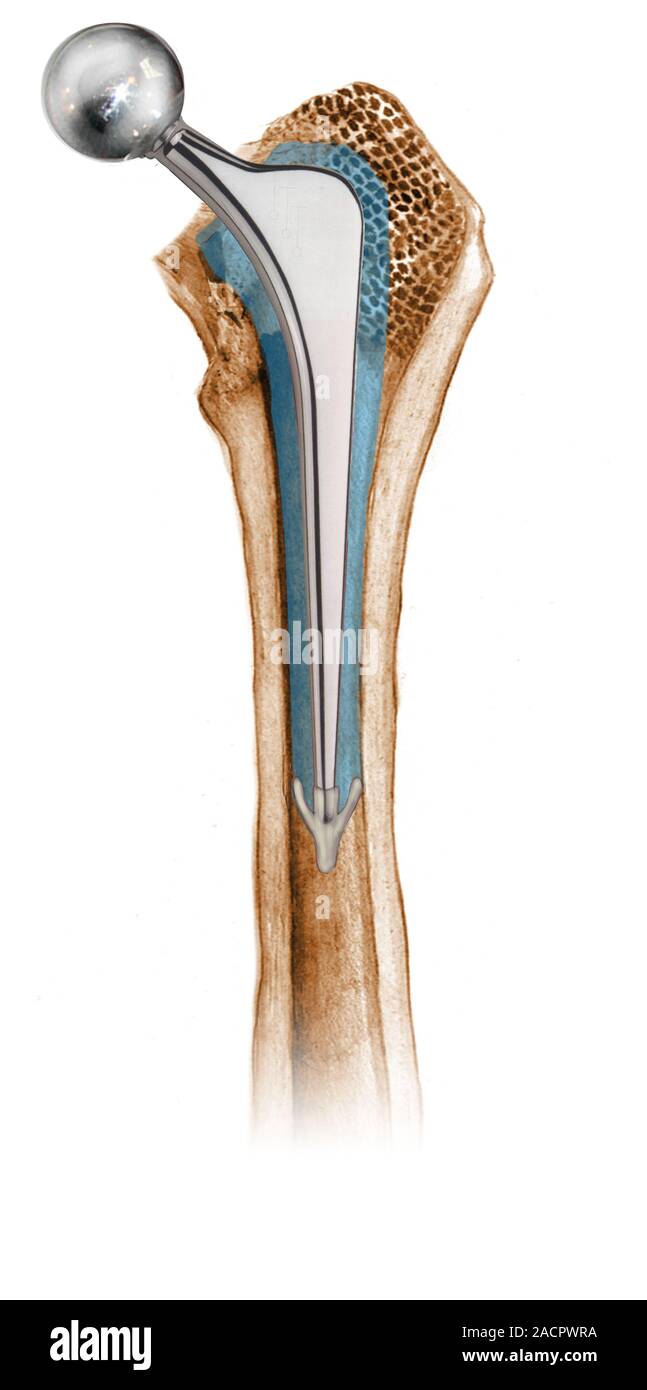 Les prothèses de la hanche. L'oeuvre en coupe d'un fémur (os de la ...
