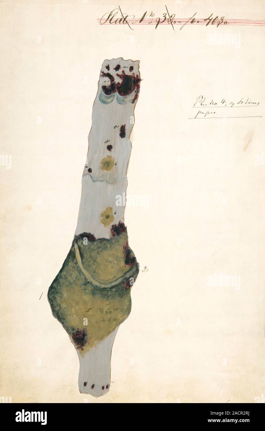 Veine fémorale dans un cas de pyaemia. 19ème siècle Illustration d'une ...