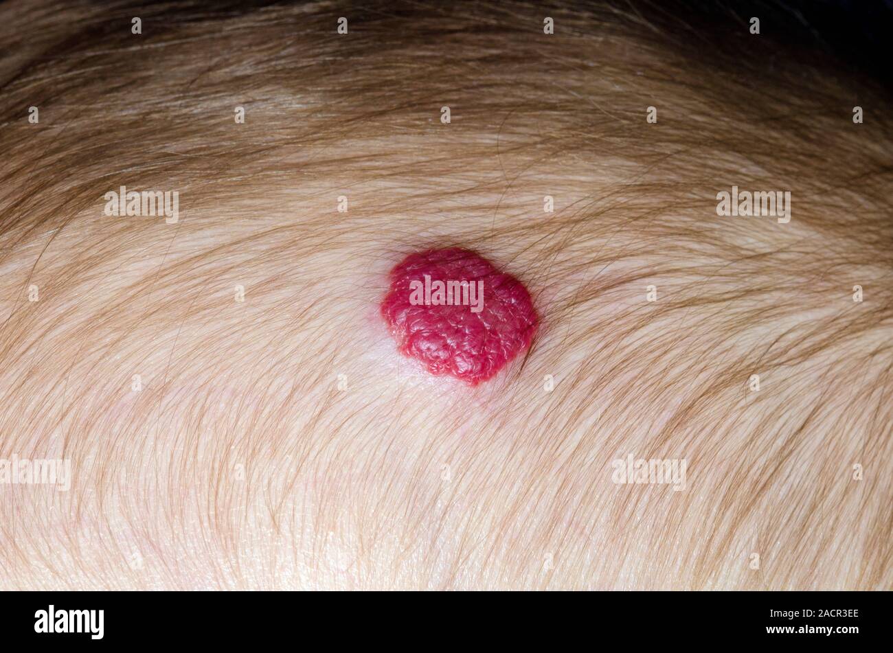 Naevus de fraise sur le cuir chevelu d'une petite fille de 6 mois. C ...