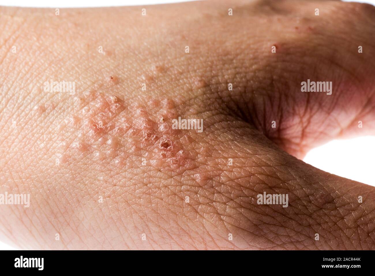 L'eczéma. Close-up de l'eczéma sur la main d'un patient. L'eczéma est ...
